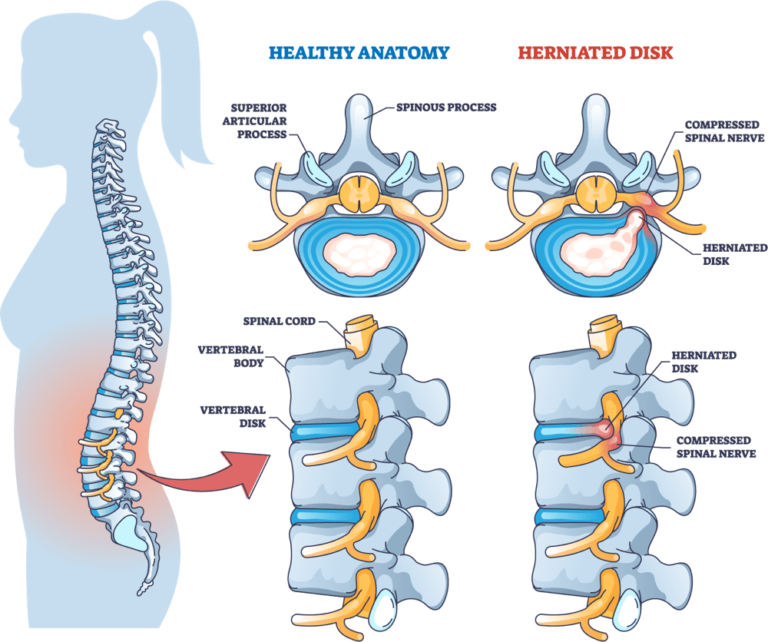 Disc Therapy in Aurora & Centennial, CO | New Hope Family Wellness